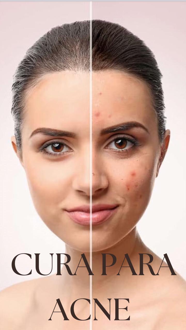 CURA PARA ACNE - Thiago Costa de Almeida mendonça | Hotmart