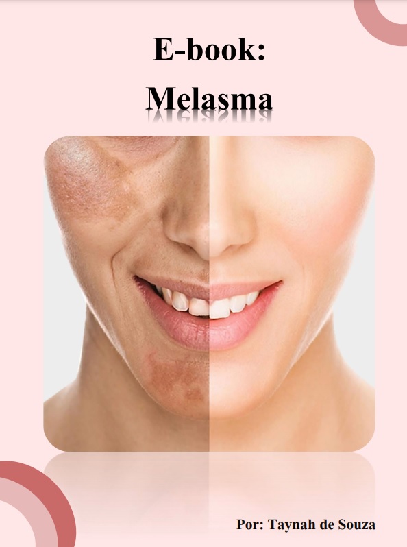 Guia do melasma - Tudo o que você precisa saber para tratar - Tayna...