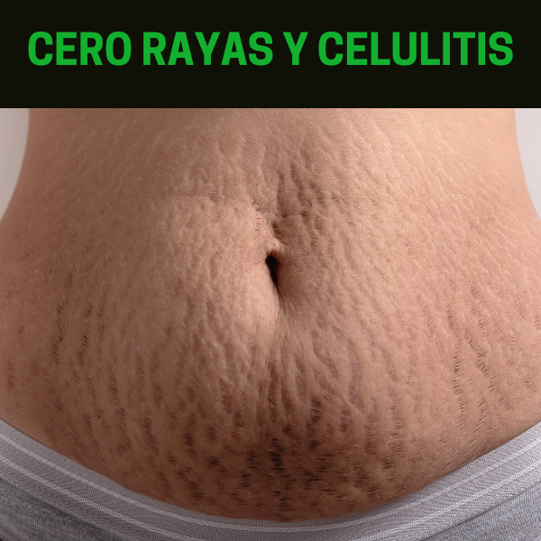 CERO CELULITIS - Lucas Miguel de Souza Pereira | Hotmart