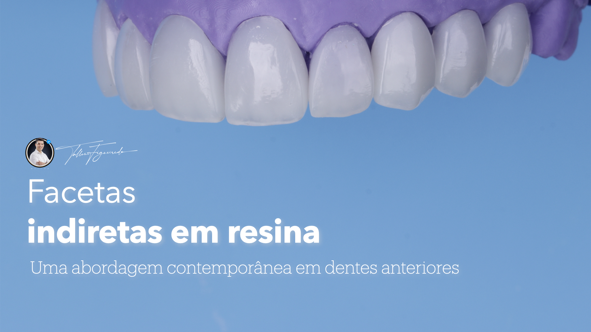 Domine a Técnica de Facetas Indiretas em Resina Composta - Talles F...