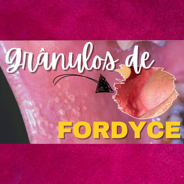 PDF - Grânulos de Fordyce - Características Clínicas, histológicas ...