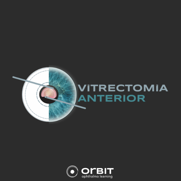 Vitrectomia Anterior - Orbit | Hotmart