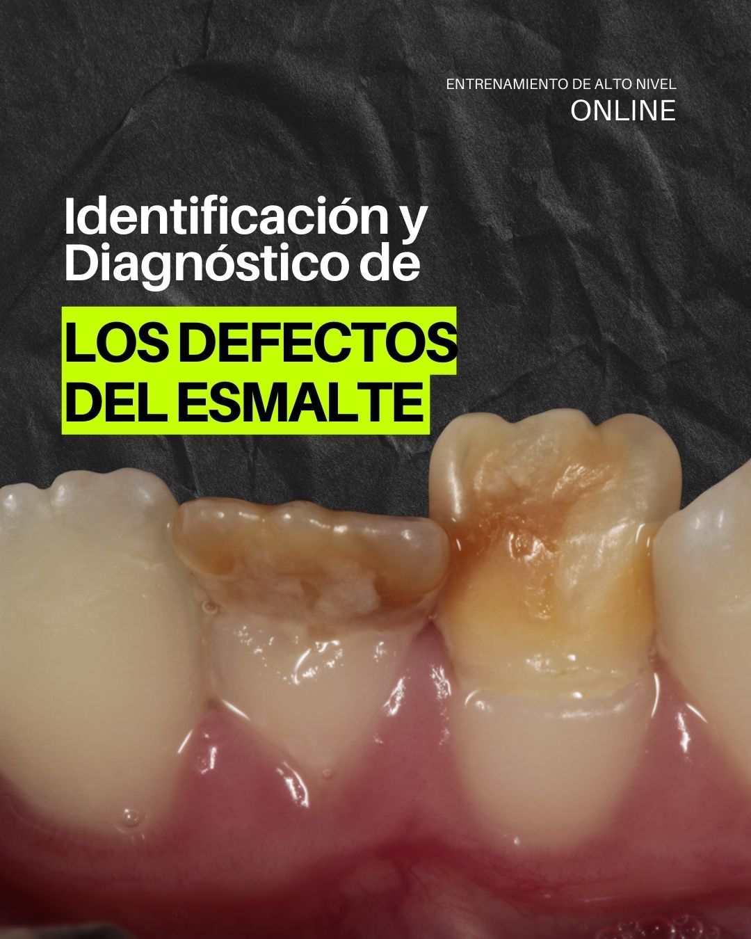 Identificación y Diagnóstico de Los Defectos del Esmalte - Alfredo ...