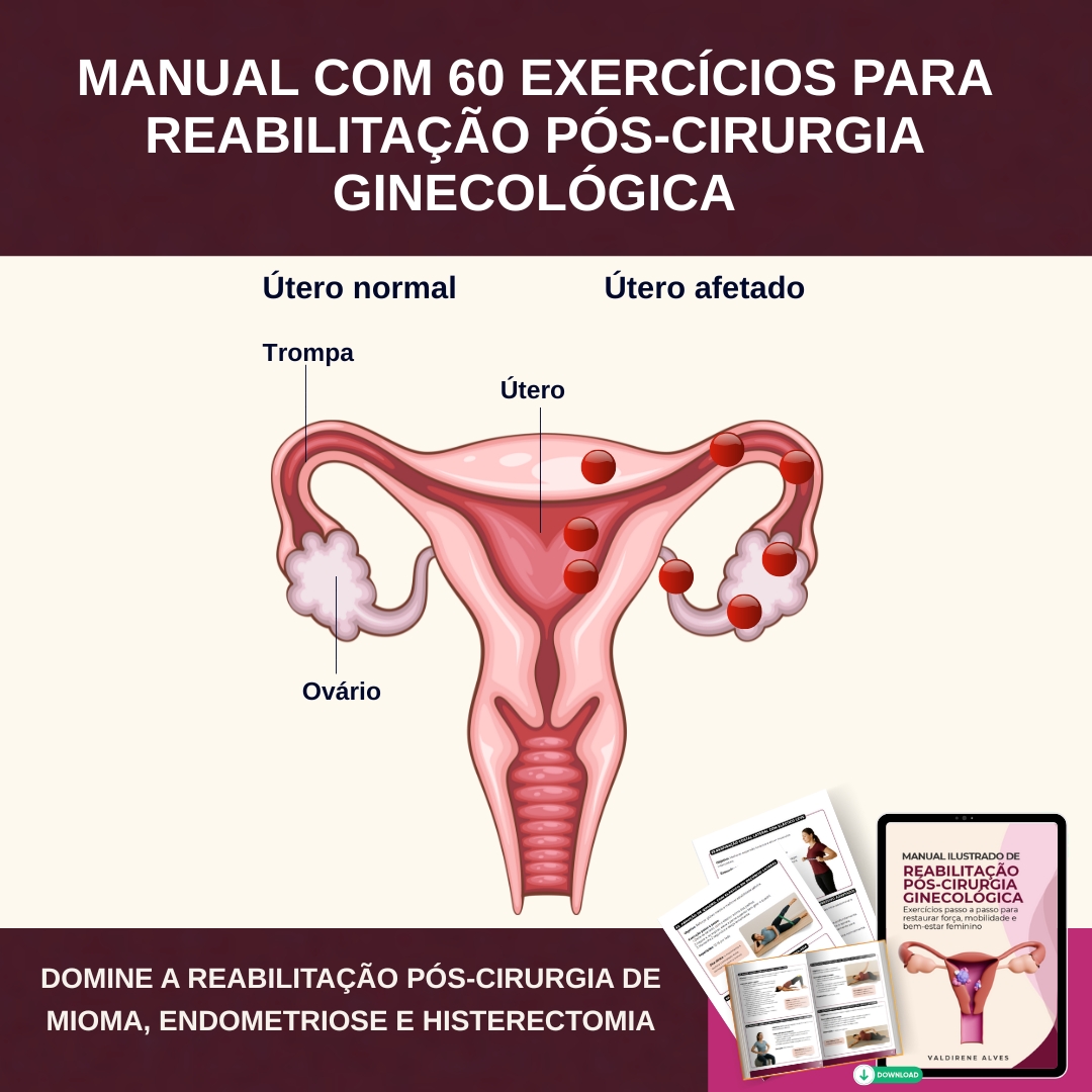 Manual Ilustrado De ReabilitaÇÃo PÓs Cirurgia GinecolÓgica Mioma