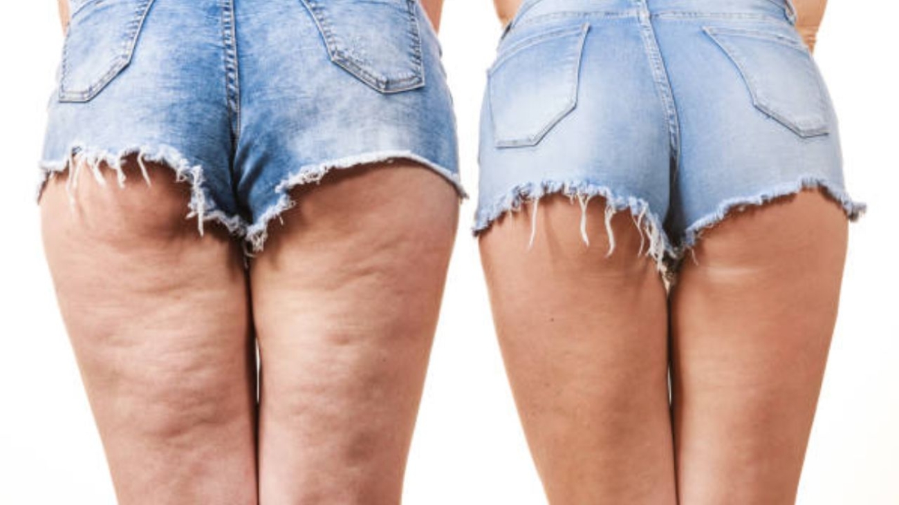 ZERO FLACIDEZ Y CELULITIS - Izidine Ambasse | Hotmart