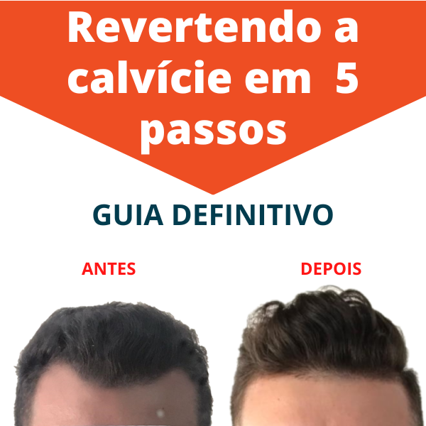COMO REVERTER A CALVÍCIE EM APENAS 5 PASSOS - Matheus Nascimento