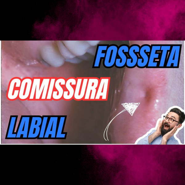 PDF - Fosseta da comissura labial - Características clínicas ...