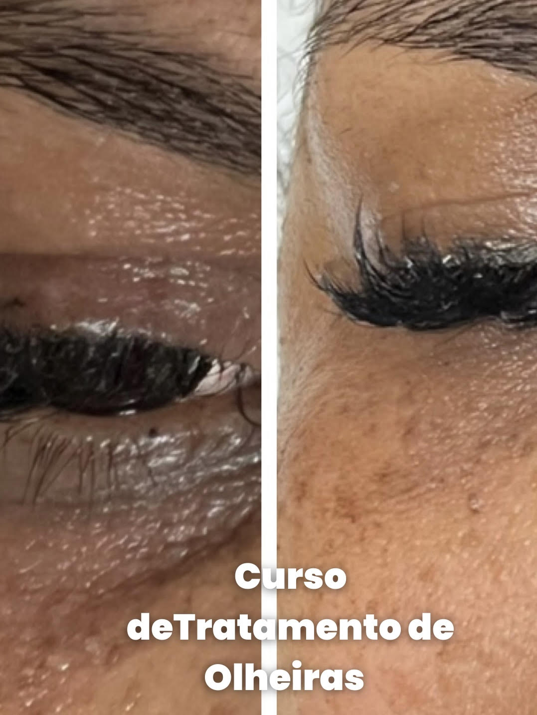 Curso Master Em Tratamento De Pigmentação De Olheiras Ana Claudia