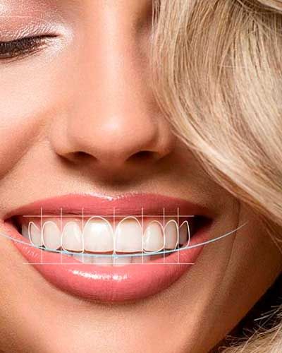 Ceramic Laminates - manuela gomes botelho felix | Hotmart