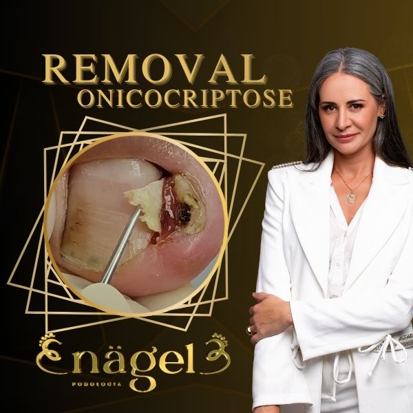 Removal - Onicocriptose - Nagel Cursos | Hotmart