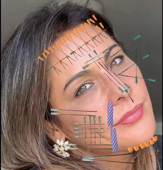 Harmonização Facial com Fios de PDO lisos e espiculados: manual prá...