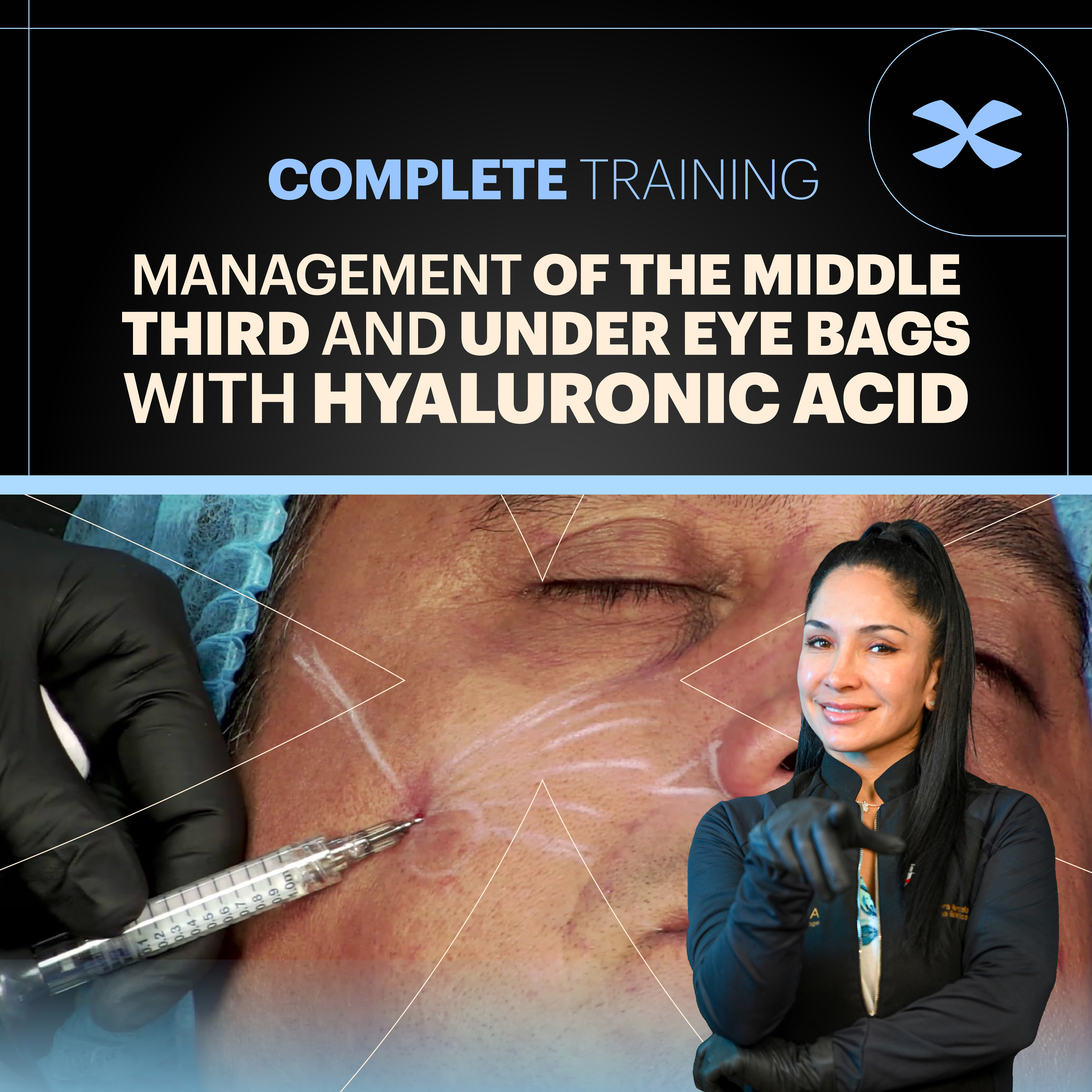 Management of the middle third and under eye bags with hyaluronic acid ...