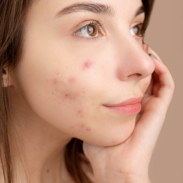 Acne Sob Controle: Explorando Causas e Tratamentos para uma Pele Ra...