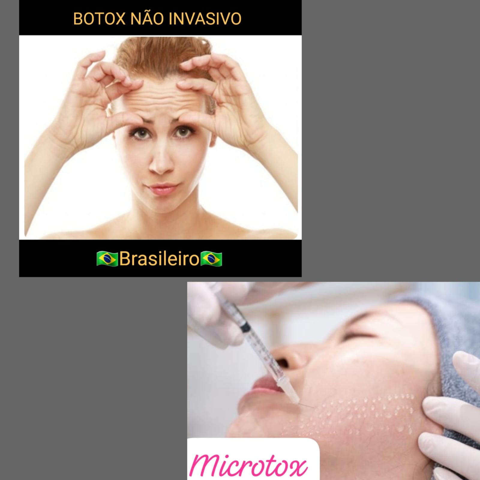 Botox Não Invasivo + Microtox - Mesobotox- Microbotox - Cristiane C...