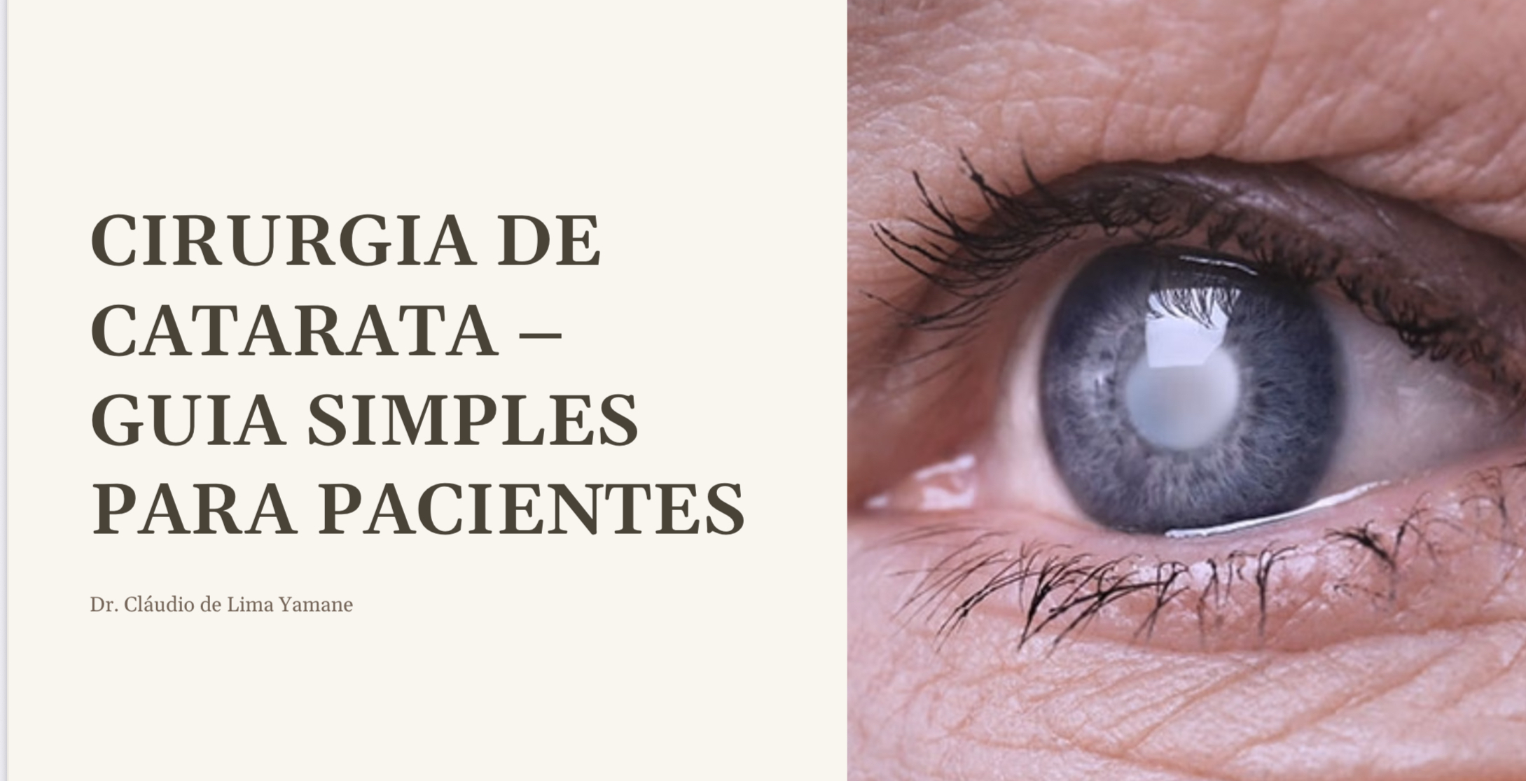 CIRURGIA DE CATARATA - GUIA SIMPLES PARA PACIENTES - Cláudio de Lim...